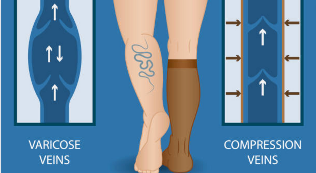 How Varicose Veins Stockings Support Leg Health – KRIGO